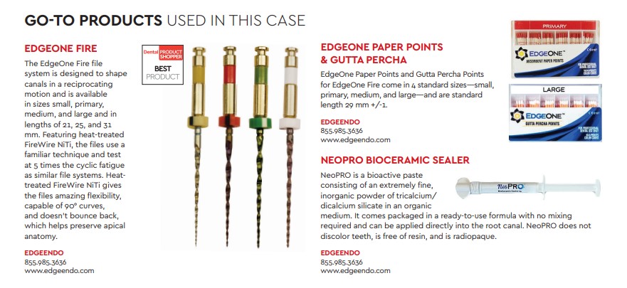 Successful Root Canal Therapy with | DPS