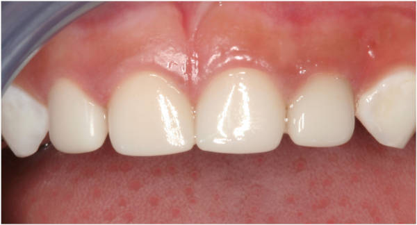 Sprig Dental Crowns: Ez Crown Dental Implants – DEMWSJ