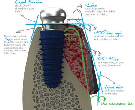 i-Gen Titanium Mesh Membrane | Integrated Dental Systems