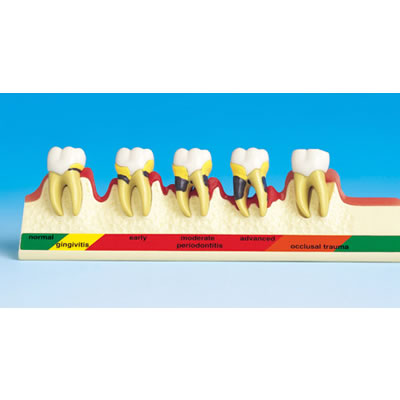 PERIODONTAL DISEASE MODEL | Nissan Dental Products Inc.