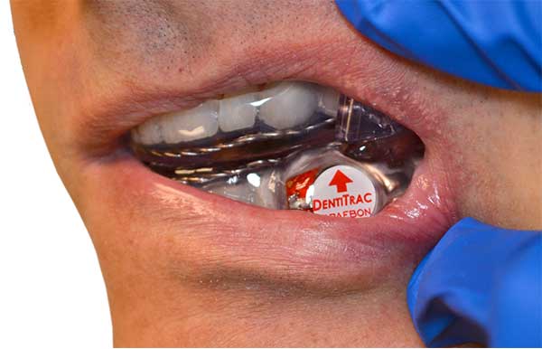 Somnomed Oral Appliance