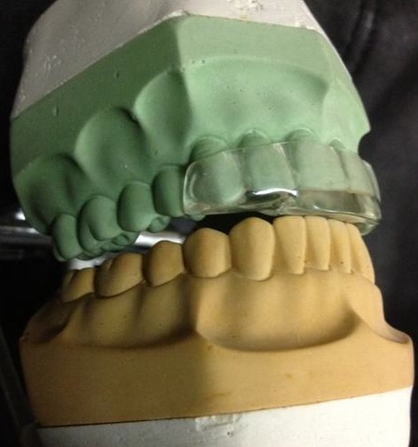 Steinway Anterior Deprogrammer/Lucia Type | Steinway Fisher Lab.