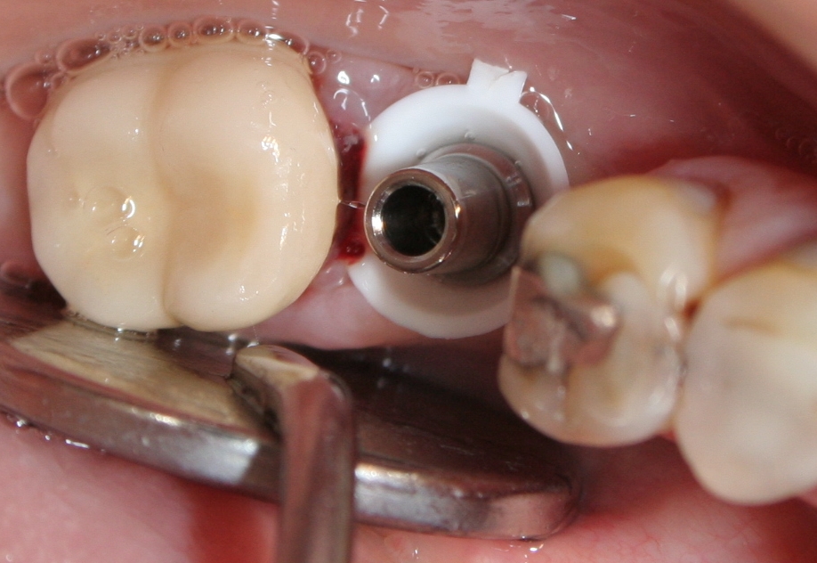 G-Cuff Temporary Gingival Support for Implant | Stomatotech